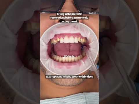 Dental bridge procedure | smile makeover | Dr. Yazdan #cosmeticdentistry | porcelain crowns #dentist