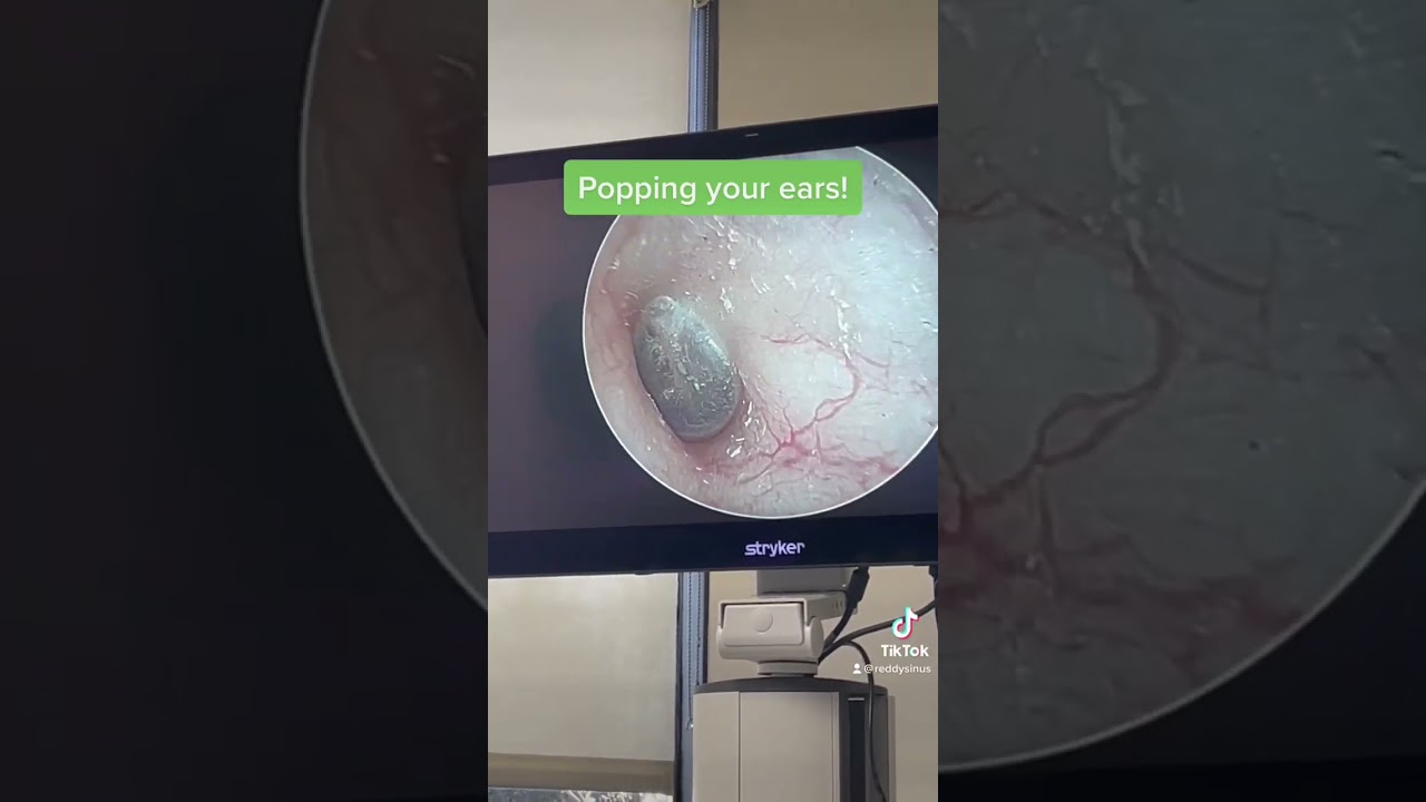 Popping / equalizing ear pressure for airplanes, diving and Eustachian tube dysfunction