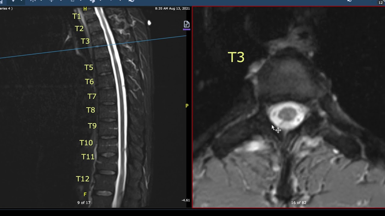 Multiple Sclerosis Vlog: Thoracic Spine MRI
