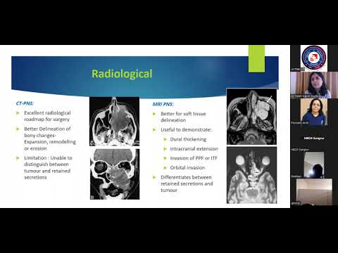 Total Maxillectomy: Steps & Indications : Dr Neeti Kapre Gupta