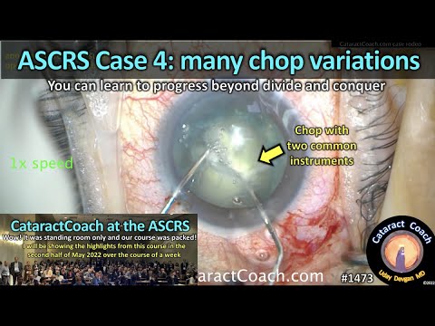 CataractCoach 1473: ASCRS case 4: many chop variations