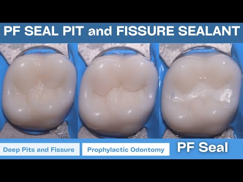 PF SEAL || Light Cure Pit and Fissure Sealant || Procedure in Maxillary Molar