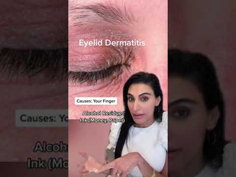 Eyelid Dermatitis #shorts | SkinByDrAzi