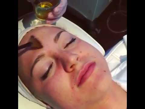 Ematrix in Miami P.R.P Plasma with Microneedling