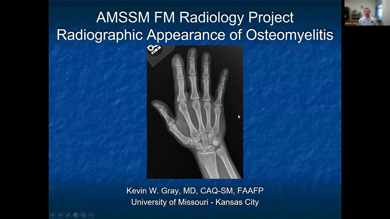 Osteomyelitis | MSK Radiology: X-Ray Educational Modules for Primary Care Residents