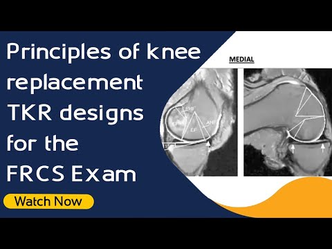 Principles of knee replacement TKR designs for the FRCS Exam | Orthopaedic Academy