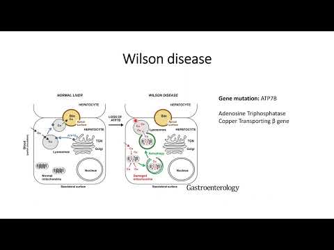Wilson Disease (Liver Malfunction): Genetic Mutation (ATP7B gene) #Code: 223