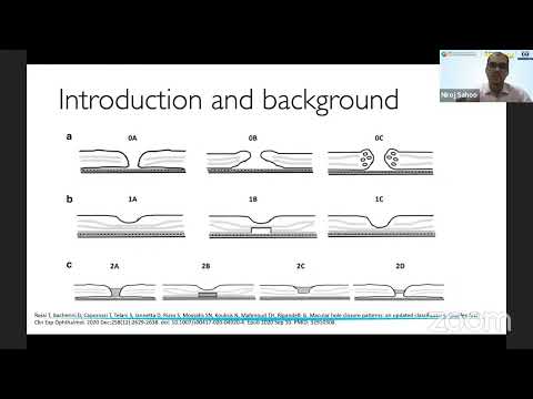THE INTRICACIES OF MACULAR HOLE SURGERIES Dr Niroj Kumar Sahoo