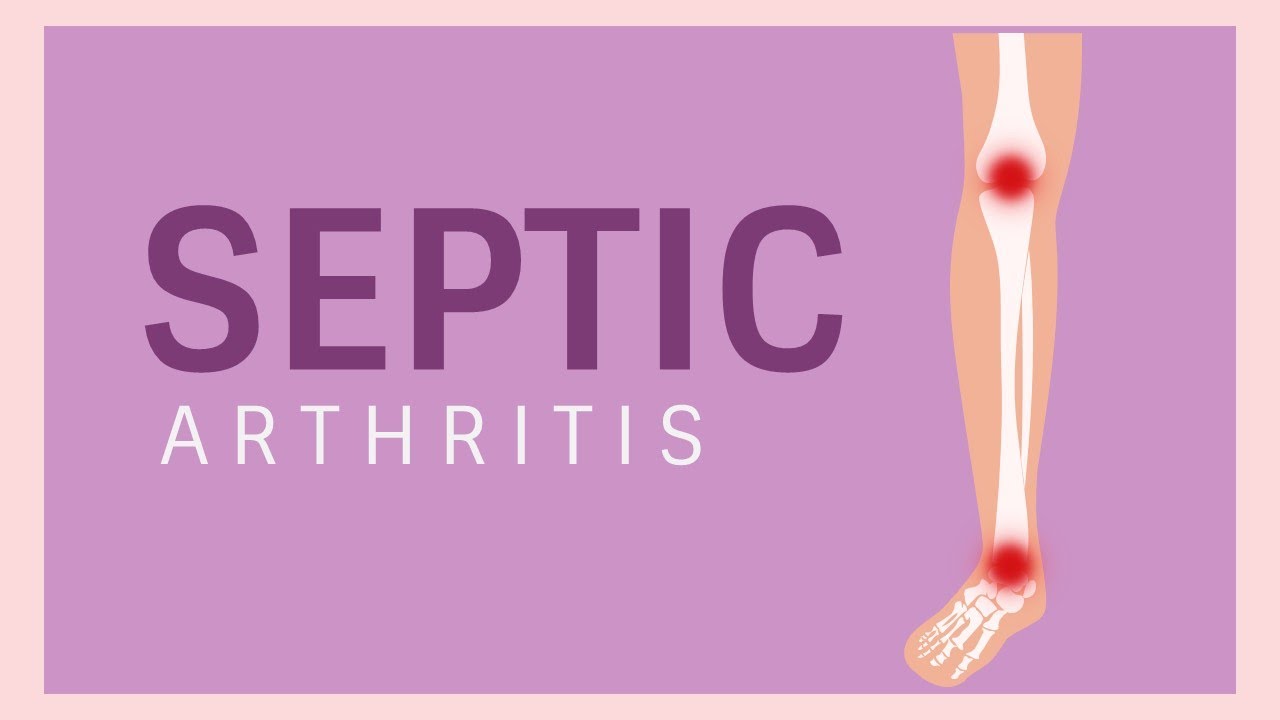 Septic Arthritis Animated PowerPoint and Google Slides Template