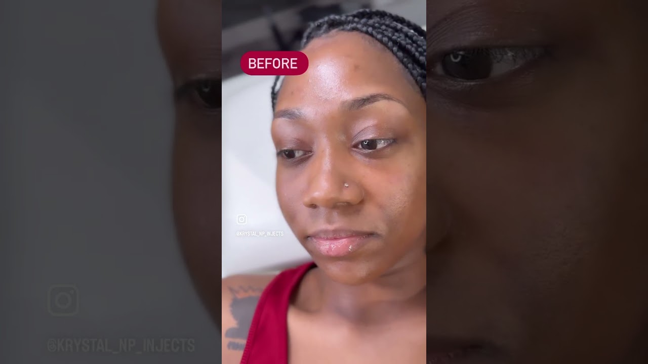 Lip filler can give you the pout of your dreams #lips #lipfillers #houston #medspa #beautytips #lip