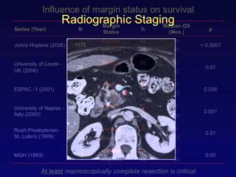 GRACEcast-147_Pancreatic_Dr. Matthew Katz: Defining Resectability of Pancreatic Cancer