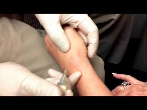 CMC Joint Injection