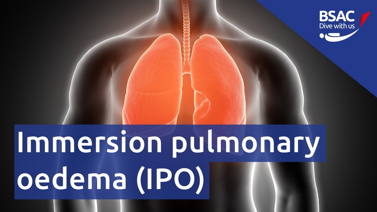 Immersion Pulmonary Edema in Diving: Understand The IPE Risk!