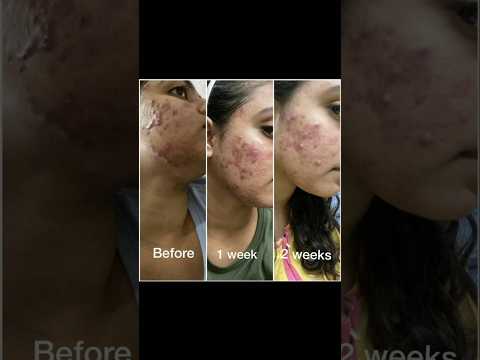 Cetaphil Facewash result in 2 week | Cetaphil Facewash for oily skin #skincare #facewashforclearskin