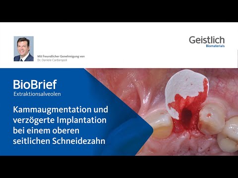Kammaugmentation und verzögerte Implantationbei einem oberen seitlichen Schneidezahn
