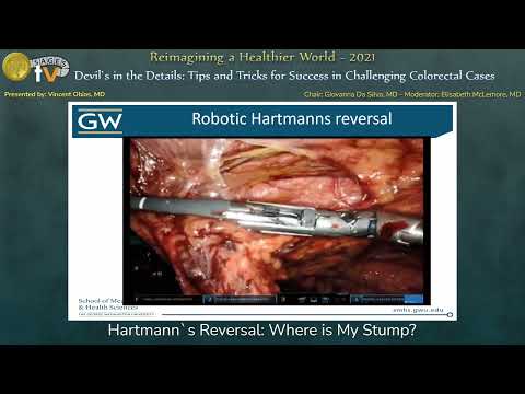 Hartmann's Reversal: Where is My Stump?