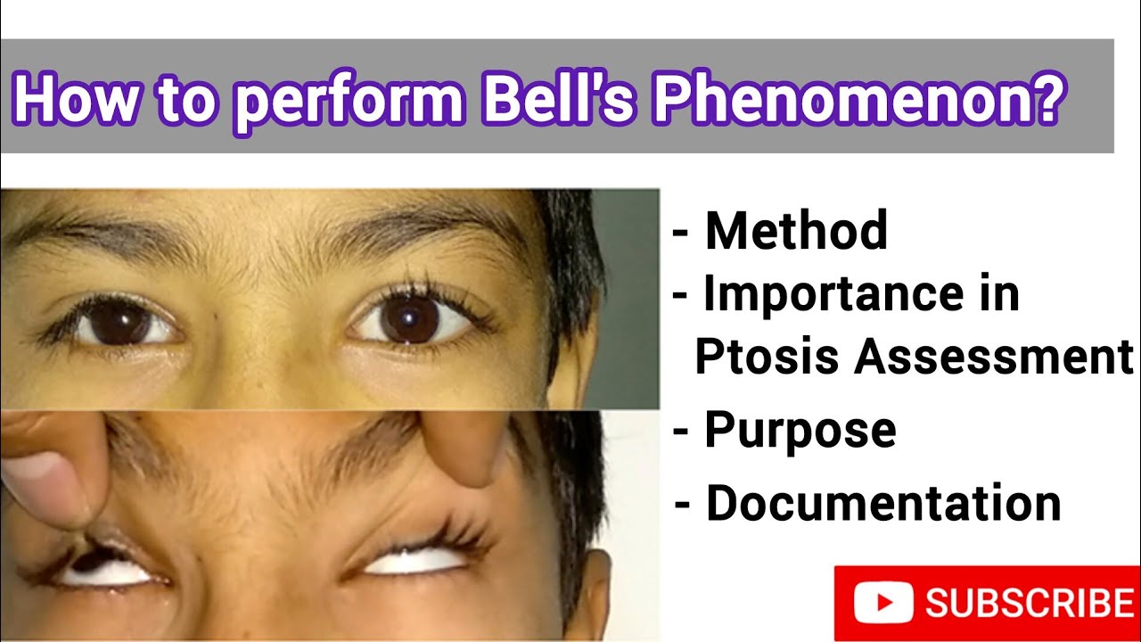 Bell's Phenomenon in Optometry | Understanding Eye Movement and Reflexes
