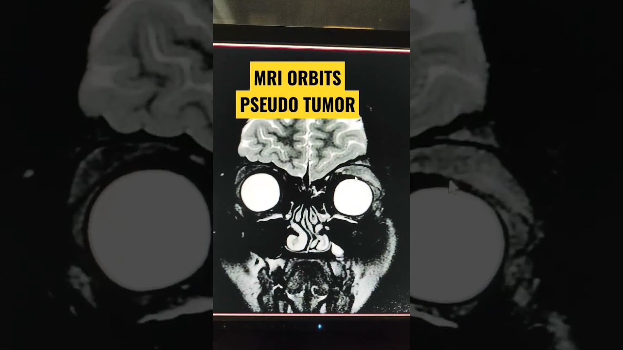 MRI of Orbits Diagnosing Pseudo Tumor #shorts #mri #viral