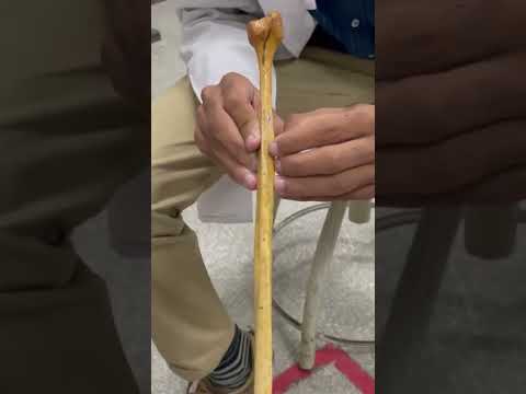 FIBULA ANATOMY|FIBULA MUSCLE ATTACHMENTS| FIBULA BONY FEATURES.