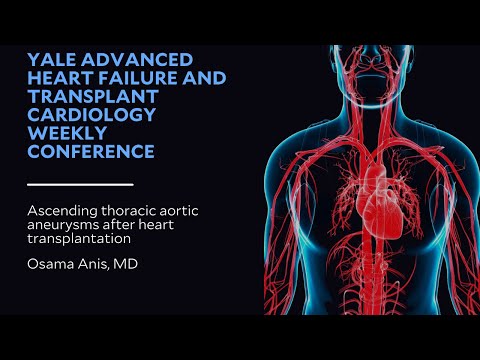 Ascending thoracic aortic aneurysms after heart transplantation