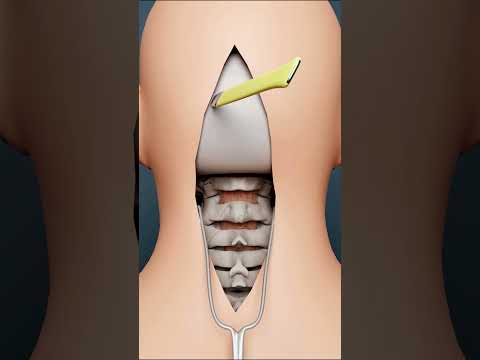 How Brain Clot Is Removed? (3D Animation) #shorts