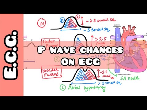 P Wave changes in ECG made easy for USMLE, NEET PG, NCLEX