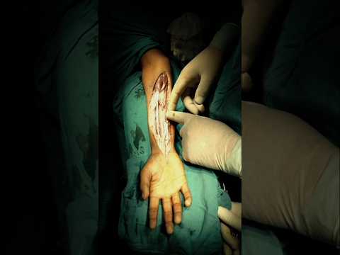Volkmann ischemic contracture (VIC) of Forearm before and after surgery #orthopedics