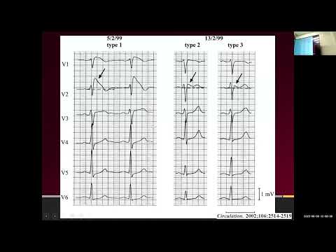 Brugada Syndrome Arrhtymia Rounds CCCC 9 6 23 Dr J Healey