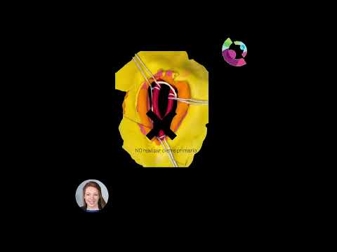 Carotid Endarterectomy Anatimation (Spanish)