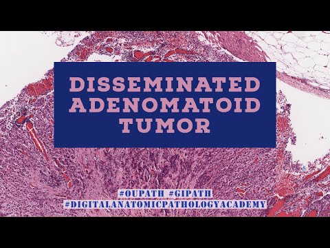 Disseminated Adenomatoid Tumor Mimicking Signet Ring Carcinoma