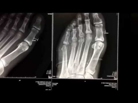 Bone Infection And Osteomyelitis In Diabetes Patient - Foot X-ray And ...