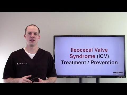 Ileocecal Valve Syndrome Symptoms