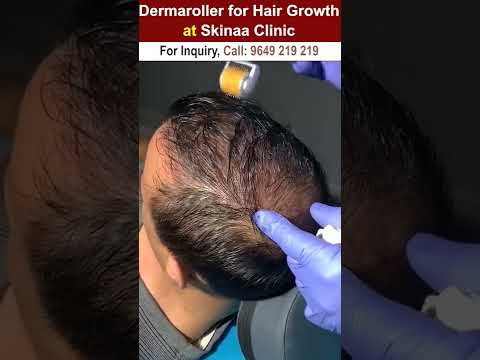 Dermaroller for hair growth #dermaroller #dermarollerforhairgrowth #hairgrowth #dermarollerforhair