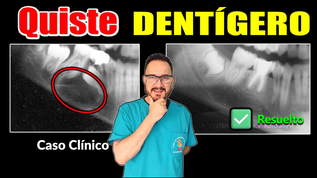 CONOCE el Diagnostico & Tratamiento de un Quiste Dentígero!