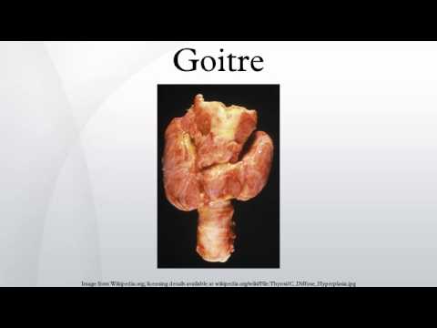 Comment guerir goitre ? La réponse est sur Admicile.fr