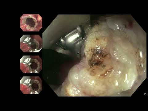 Transoral Outlet Reduction (TORe): Dr Saurabh Gupta, Sydney, Australia