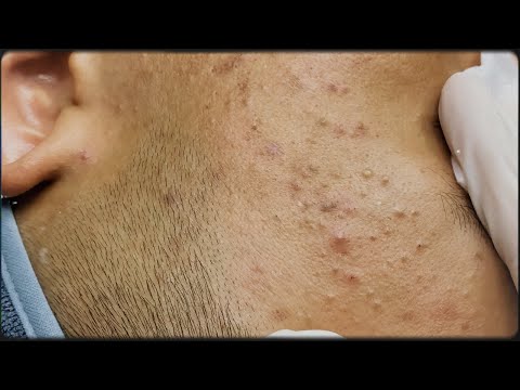Blackheads New 2025 Today EP.13