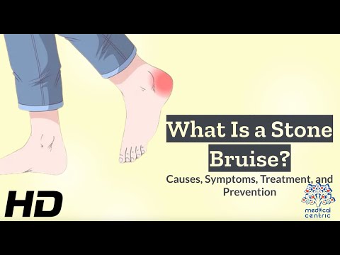 Stone Bruises Unveiled: Causes, Symptoms, and Solutions