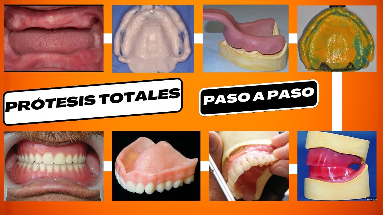 PRÓTESIS TOTALES | Prótesis total dental paso a paso.