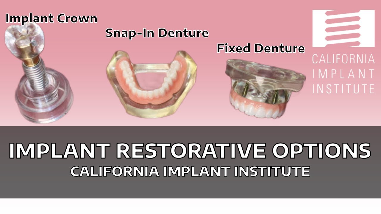 Restorative Options Once You Have Dental Implants (2024)
