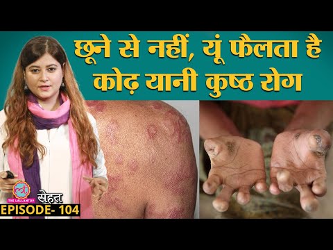 कुष्ठ रोग यानी Leprosy किसे और कैसे हो सकता है, यहां जान लीजिए | Sehat ep 104