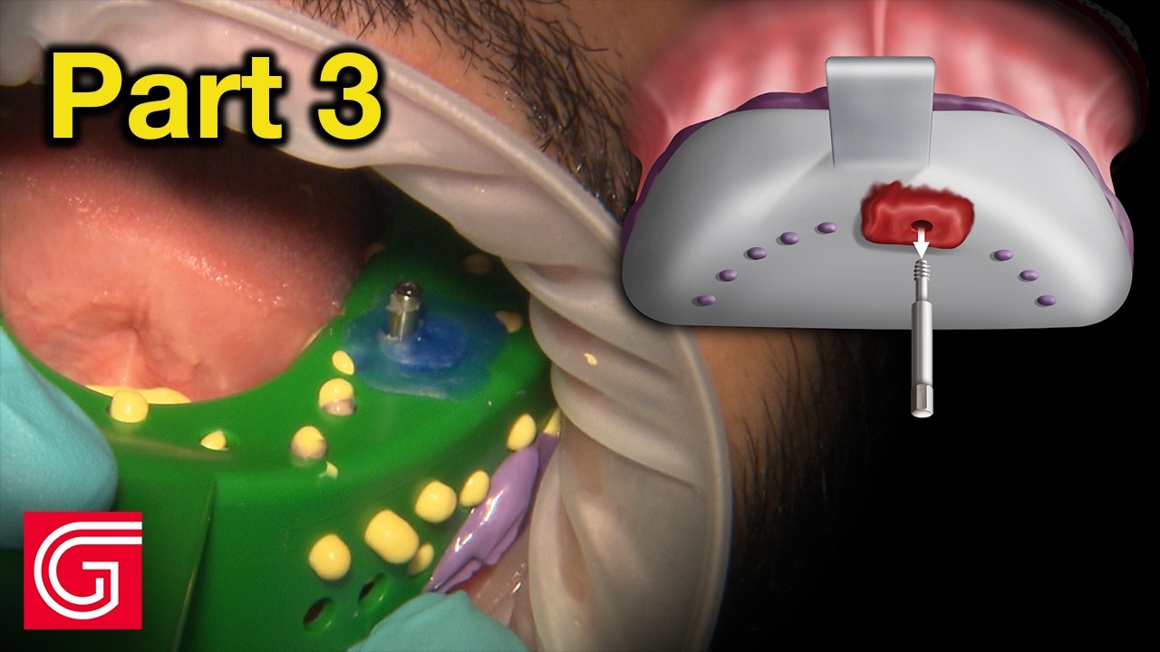 OPEN TRAY Impression Technique for IMPLANTS | Part 3