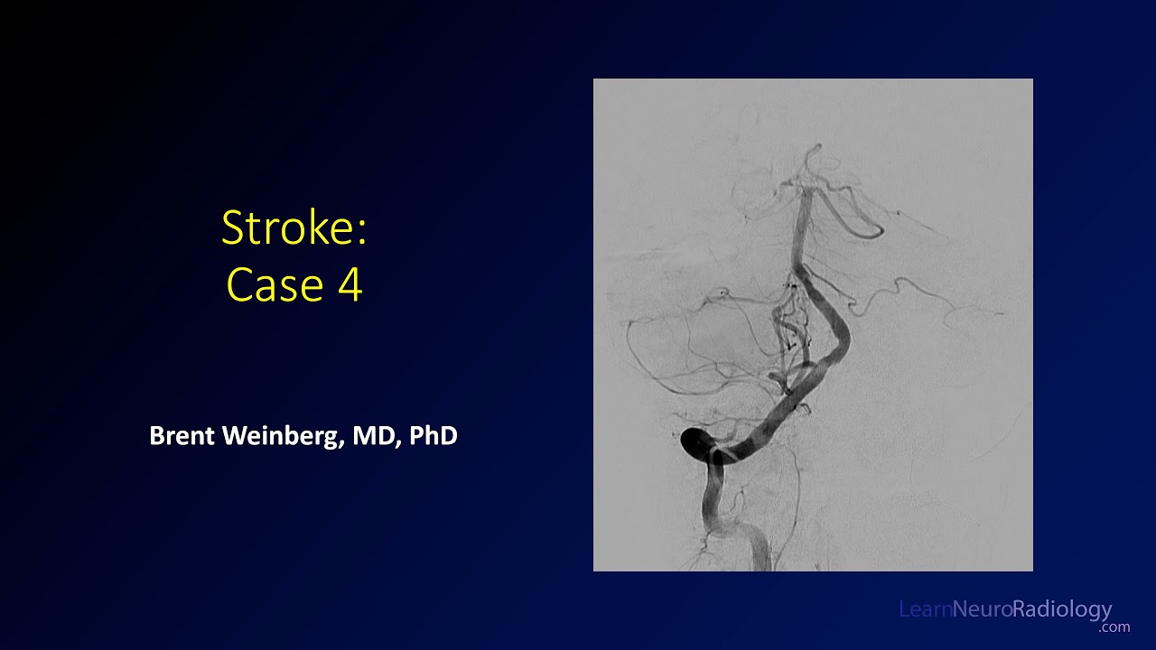 Stroke Imaging – Case 4