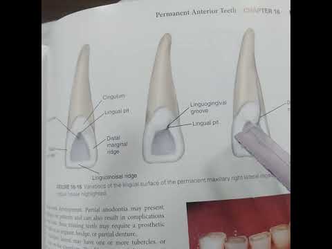 Maxillary Lateral Incisor grooves on lingual surface