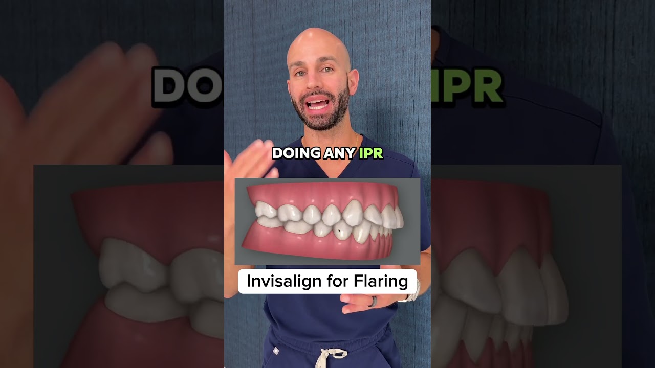 Adult Invisalign for Flared Front Teeth