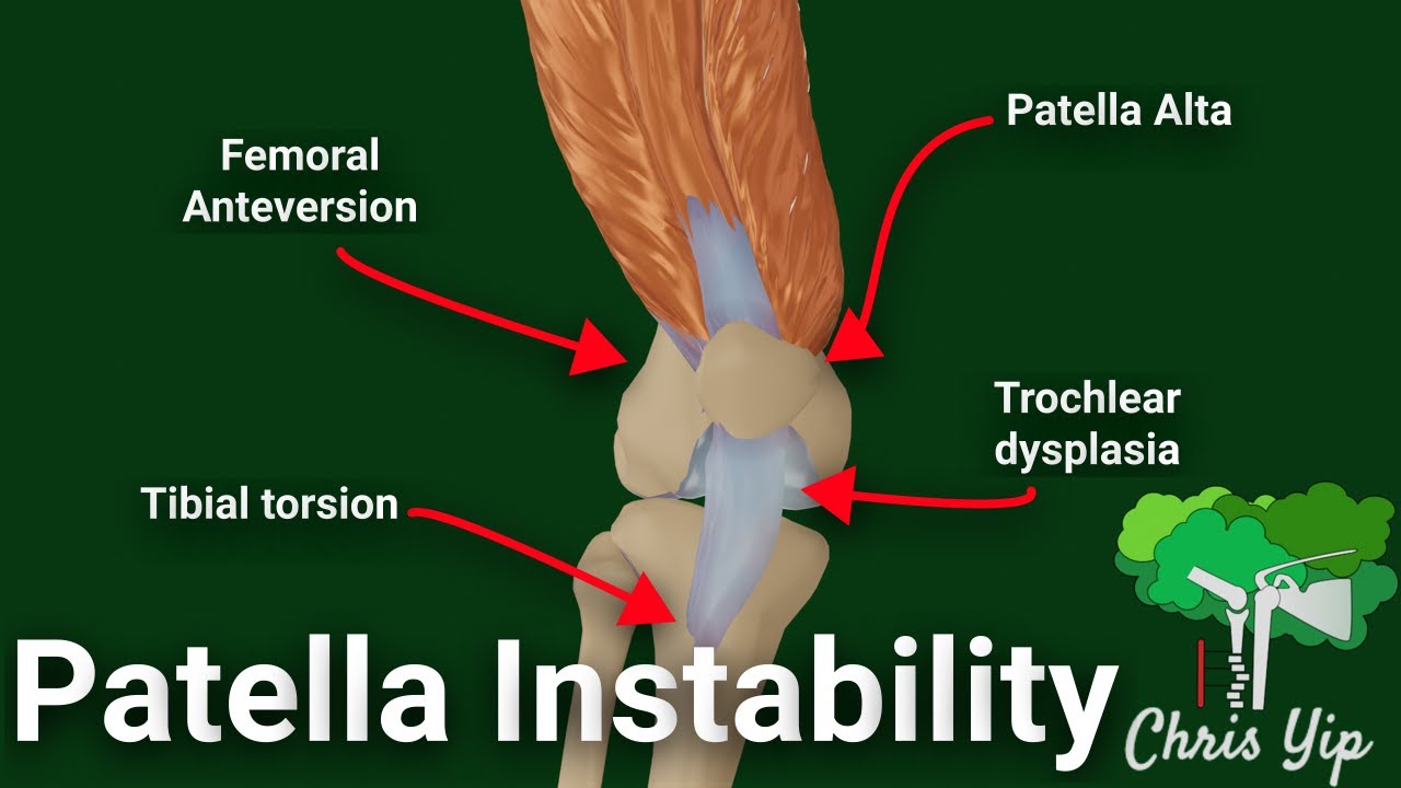 Recurrent patella instability (Animated)
