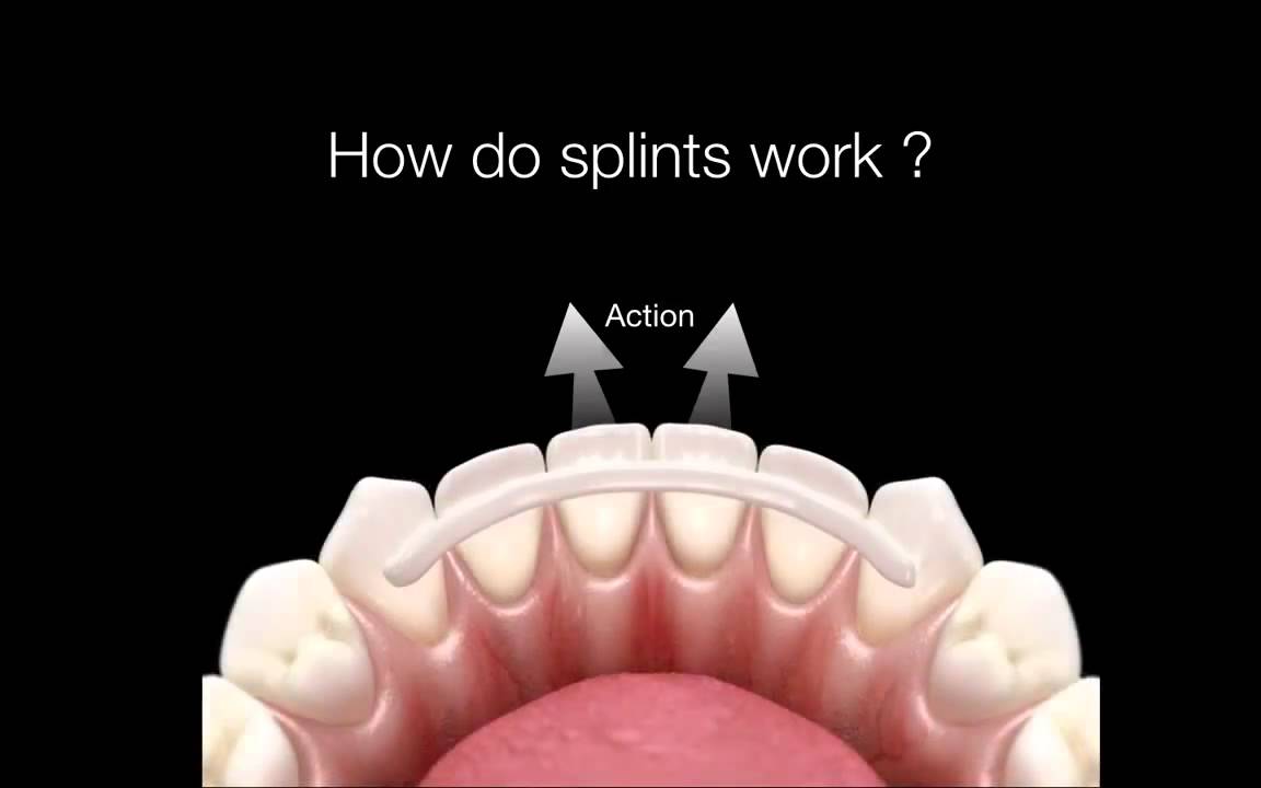 How Do Dental Splints Work