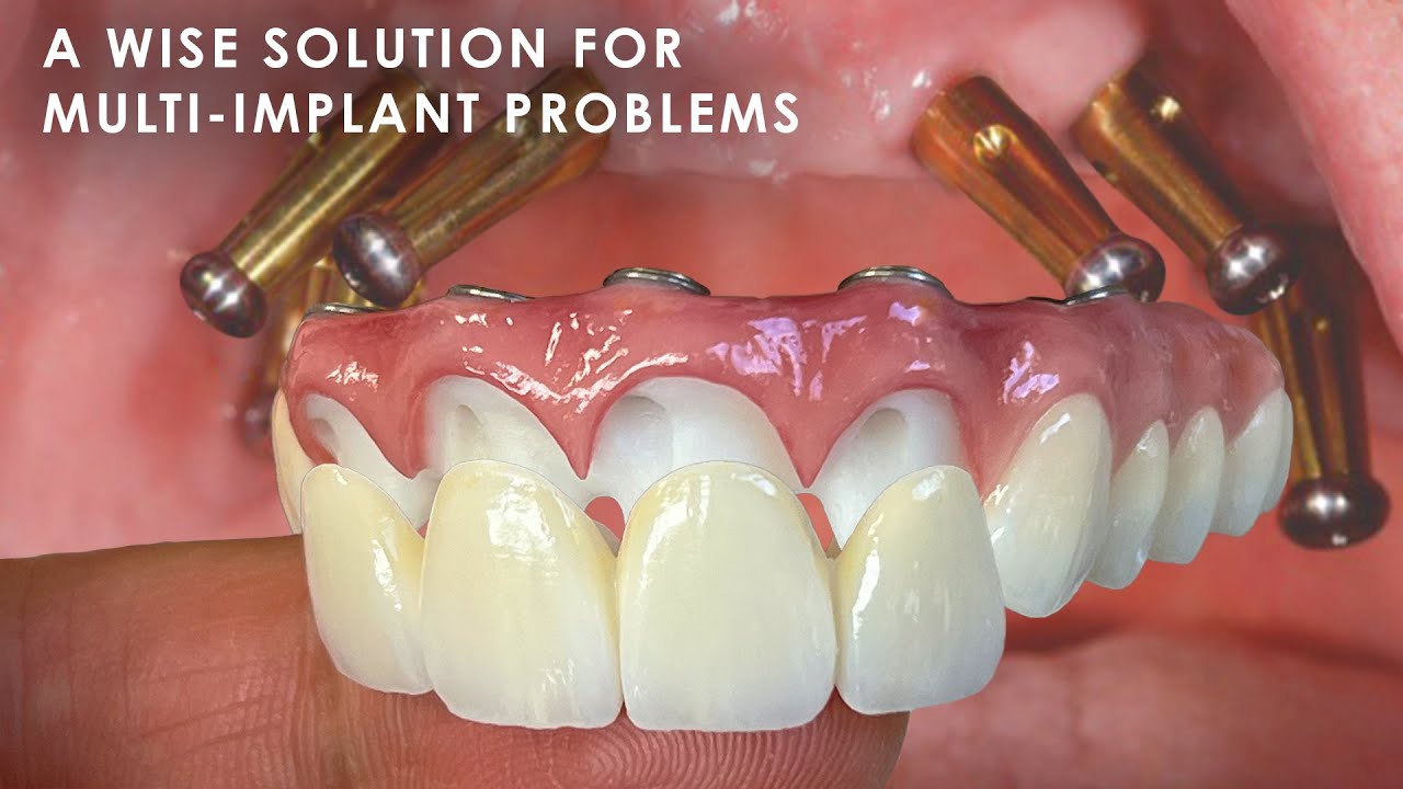 A Wise Solution for Multi-Implant Problems