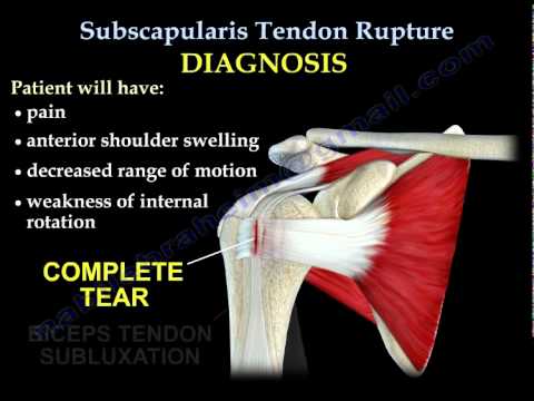 Subscapularis Tendon Rupture - Everything You Need To Know - Dr. Nabil Ebraheim