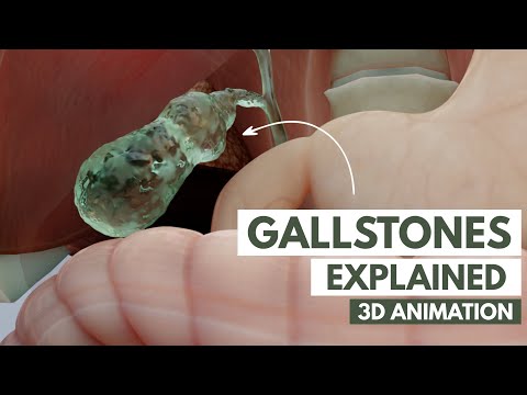 What are Gallstones? | 3D Animation